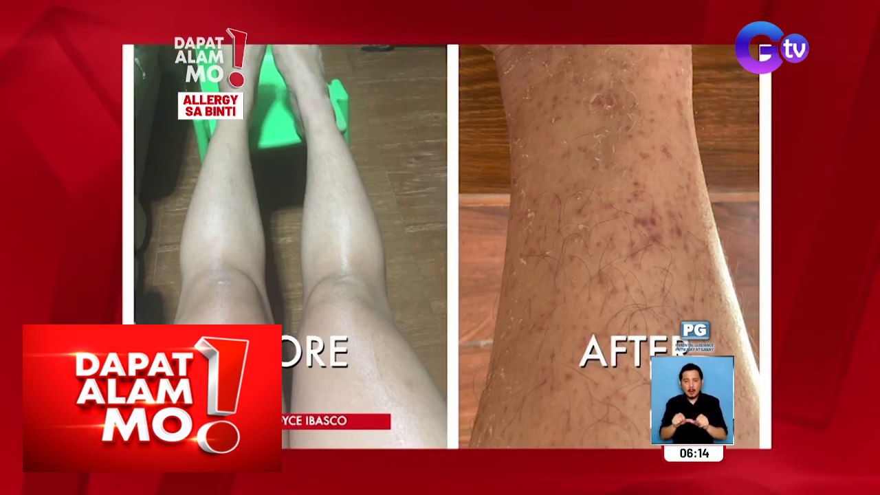 Peeling lotion, nagdulot umano ng pamumula at butlig sa balat ng isang ...