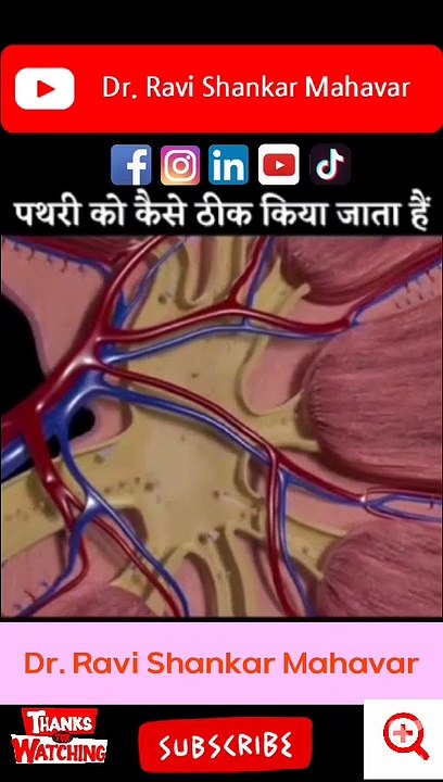 Kidney Stone ko kaise thik kare #shorts #viral @Dr. Ravi Shankar ...