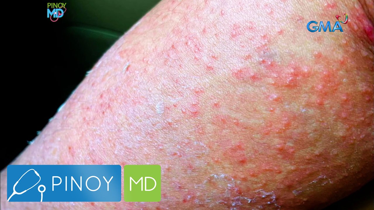 Makinis at flawless na legs, tinubuan ng butlig at pantal dahil sa ...