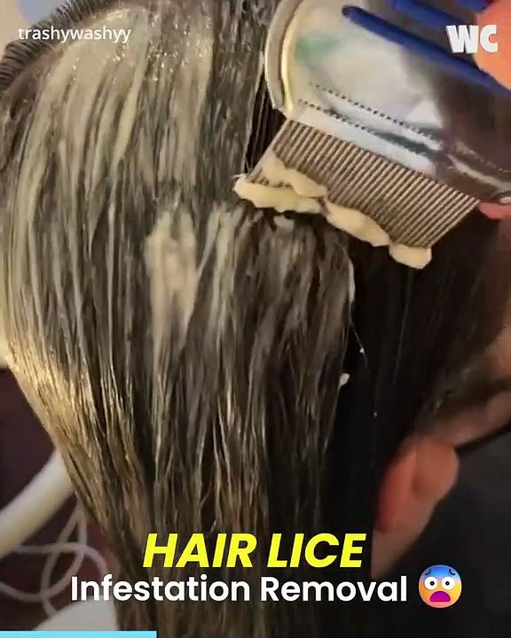Hair Lice Infestation Removal - video Dailymotion