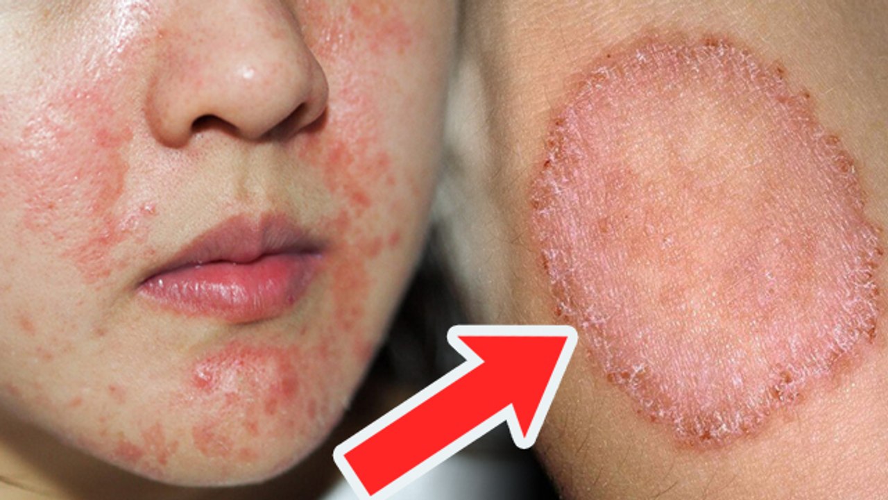 चर्म रोग क्यों होता है | चर्म रोग होने का कारण | Charm Rog Hone Ke ...