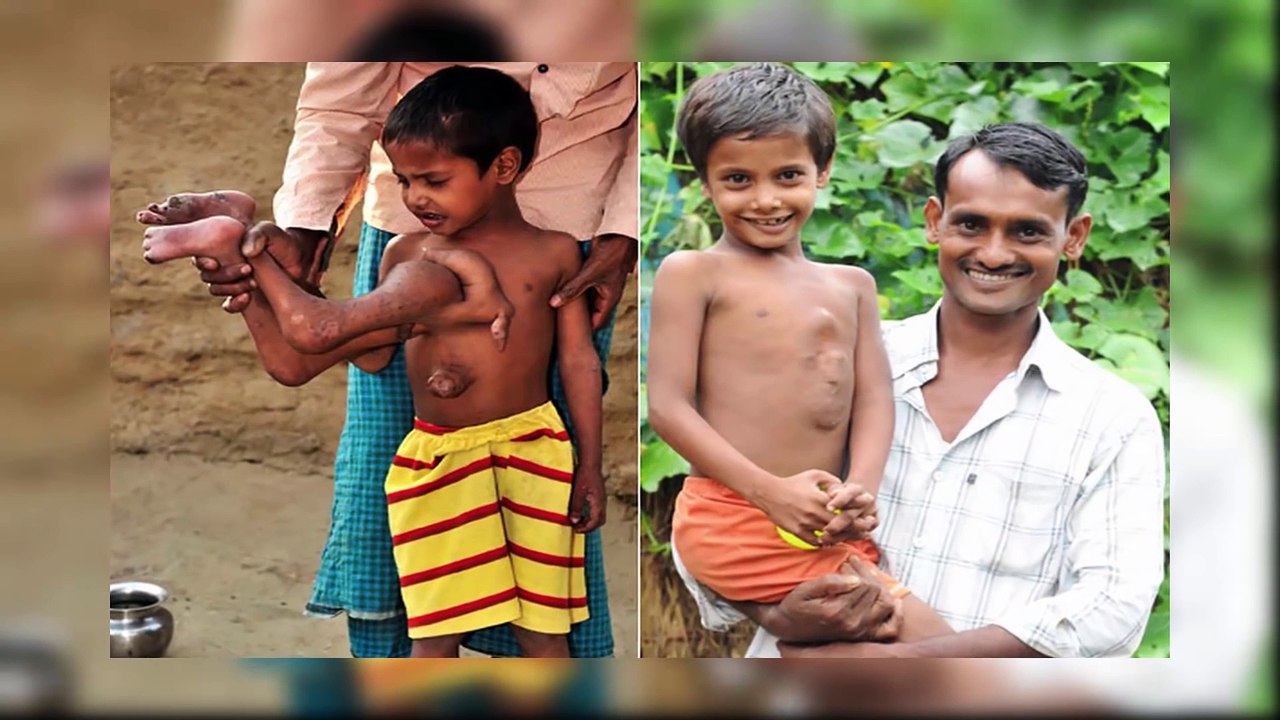 7 People With Weird Extra Body Parts - video Dailymotion