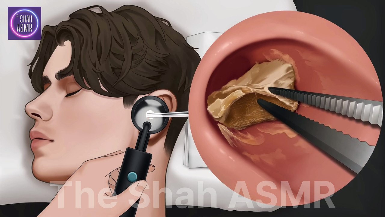 Ear Cleaning and Earwax Removal [ASMR] - video Dailymotion