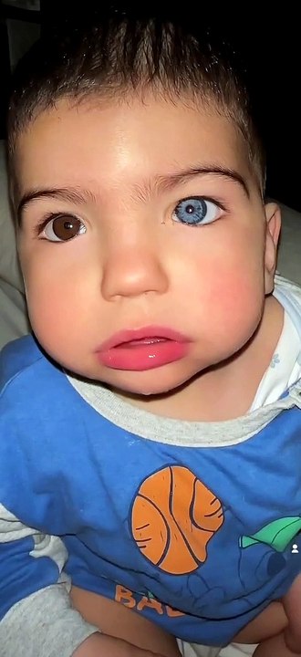 Child Shows Off Blue Brown Heterochromia - video Dailymotion