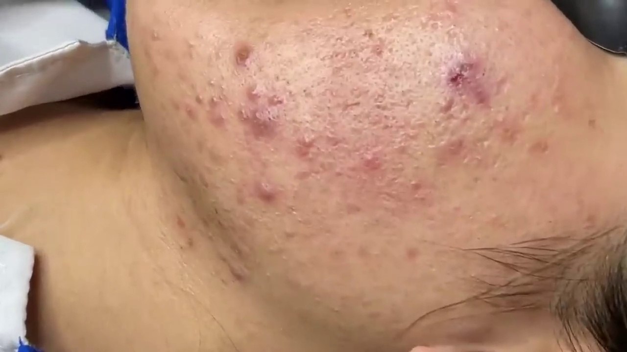 pimple popping blackheads and whiteheads | pimple popping spa - video ...