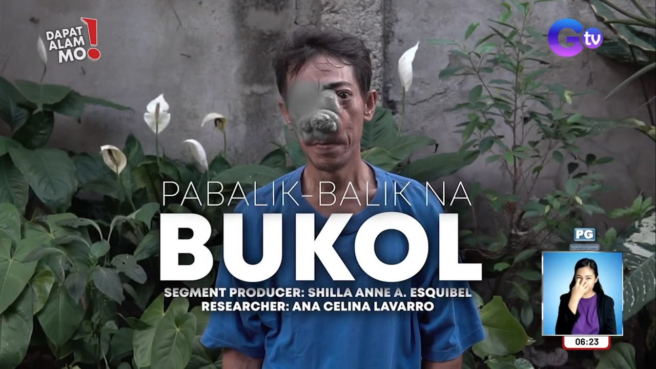 Lalaki, tatlong dekada nang iniinda ang pabalik-balik na bukol sa ilong | Dapat Alam Mo! - video ...