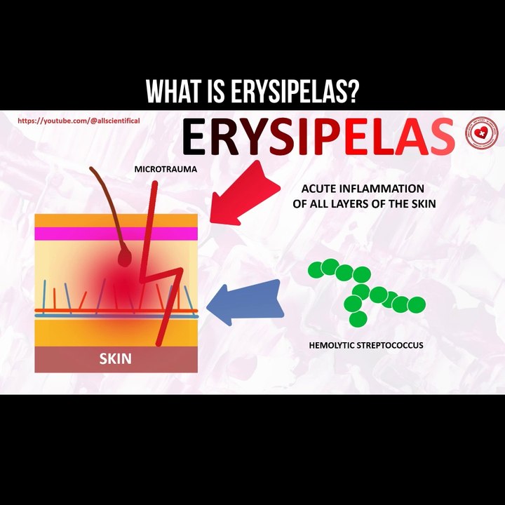What is erysipelas? - video Dailymotion