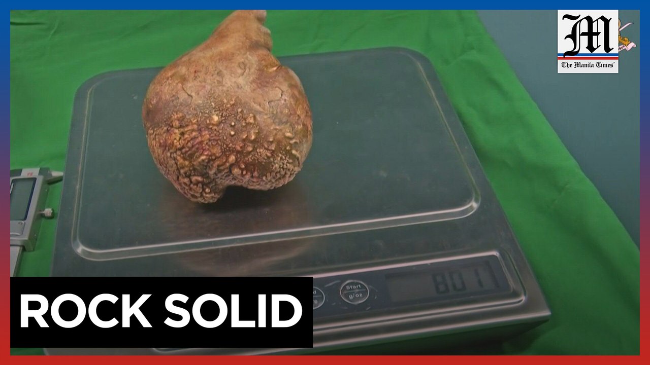 Sri Lankan doctors remove world's largest kidney stone - video Dailymotion