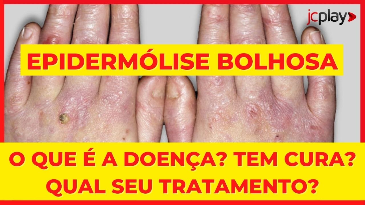 EPIDERMÓLISE BOLHOSA: O QUE É A DOENÇA? TEM CURA? QUAL SEU TRATAMENTO ...