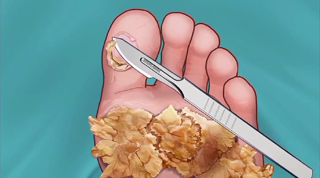 ASMR Treatment of foot Removal Animation - video Dailymotion