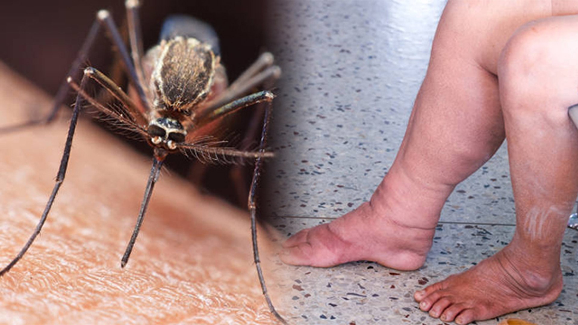 Elephantiasis Mosquito Bite