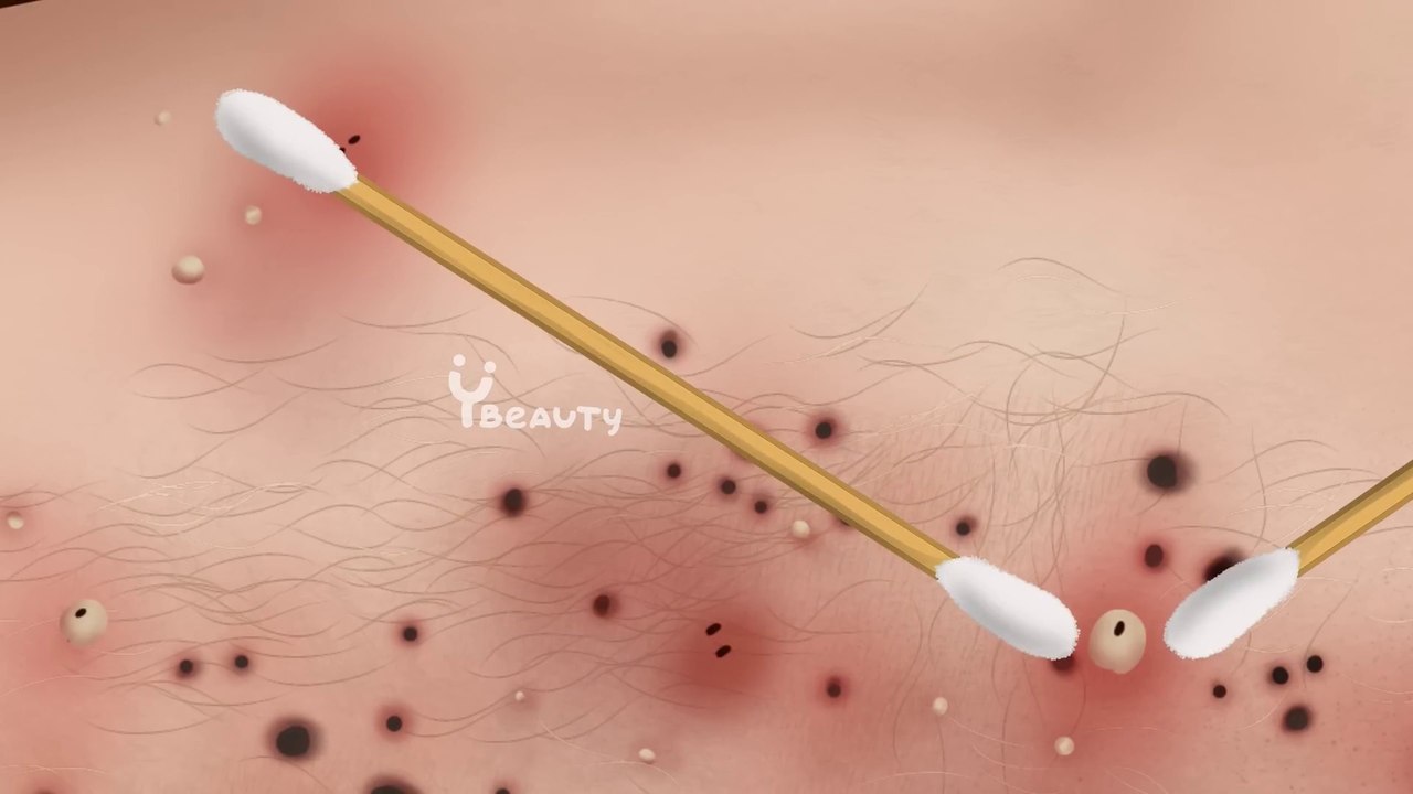 How to get rid of ASMR chest acne Most Oddly Satisfying Massive Chest ...