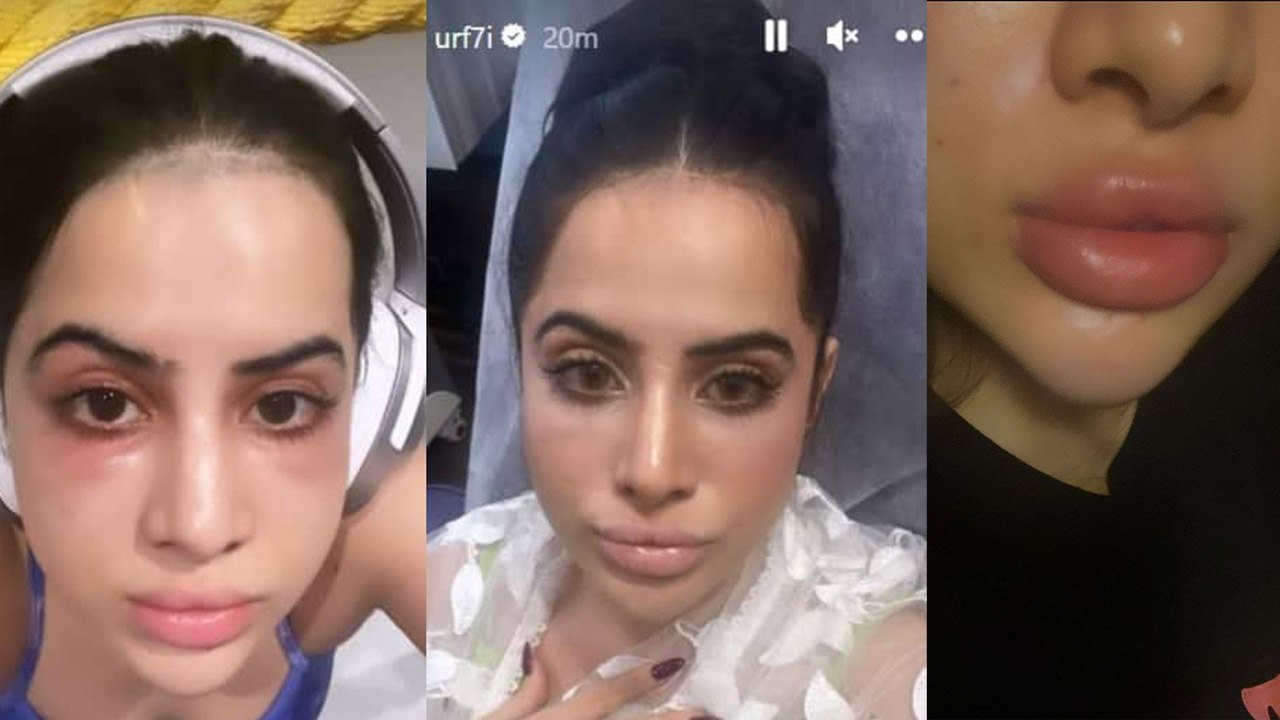 Urfi aka Uorfi Javed का खूबसूरत दिखने के चक्कर में Surgery करवा बिगड़ा ...