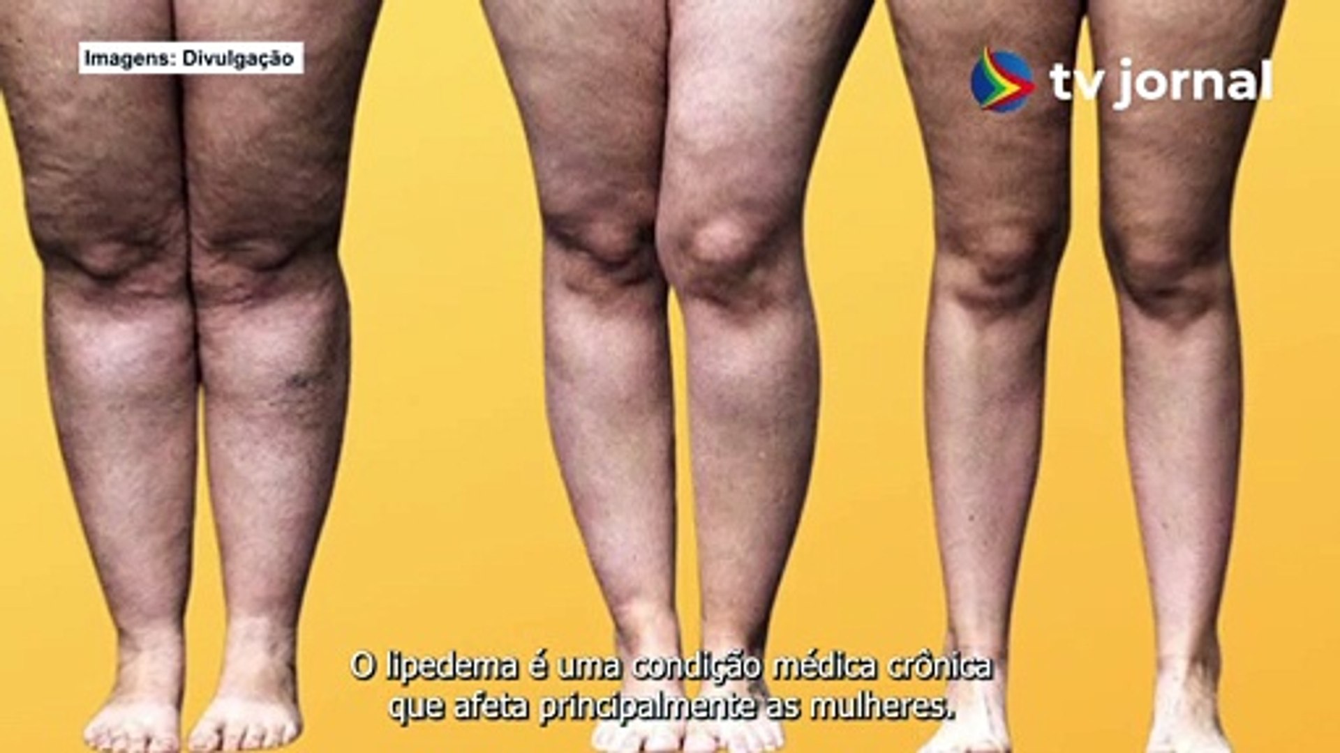 LIPEDEMA: O QUE É, QUAIS OS SINTOMAS, CAUSAS E TRATAMENTO da doença ...