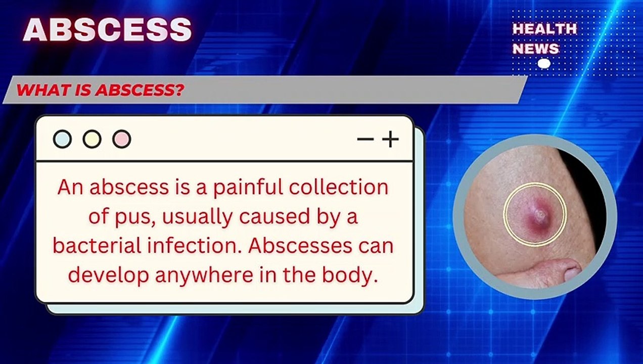 Skin Abscess Causes, Symptoms, Treatment, Prevention #abscess # ...