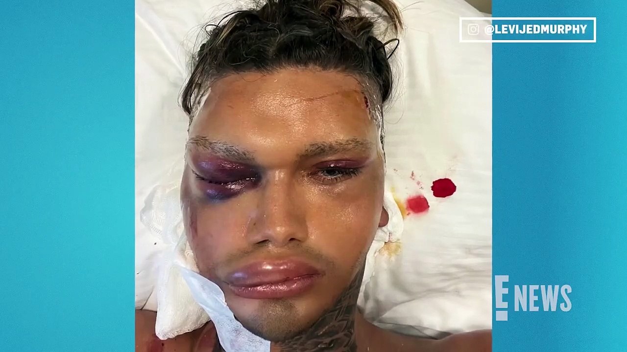 TikToker Levi Jed Murphy Shares Plans For MORE Surgery _ E! News ...