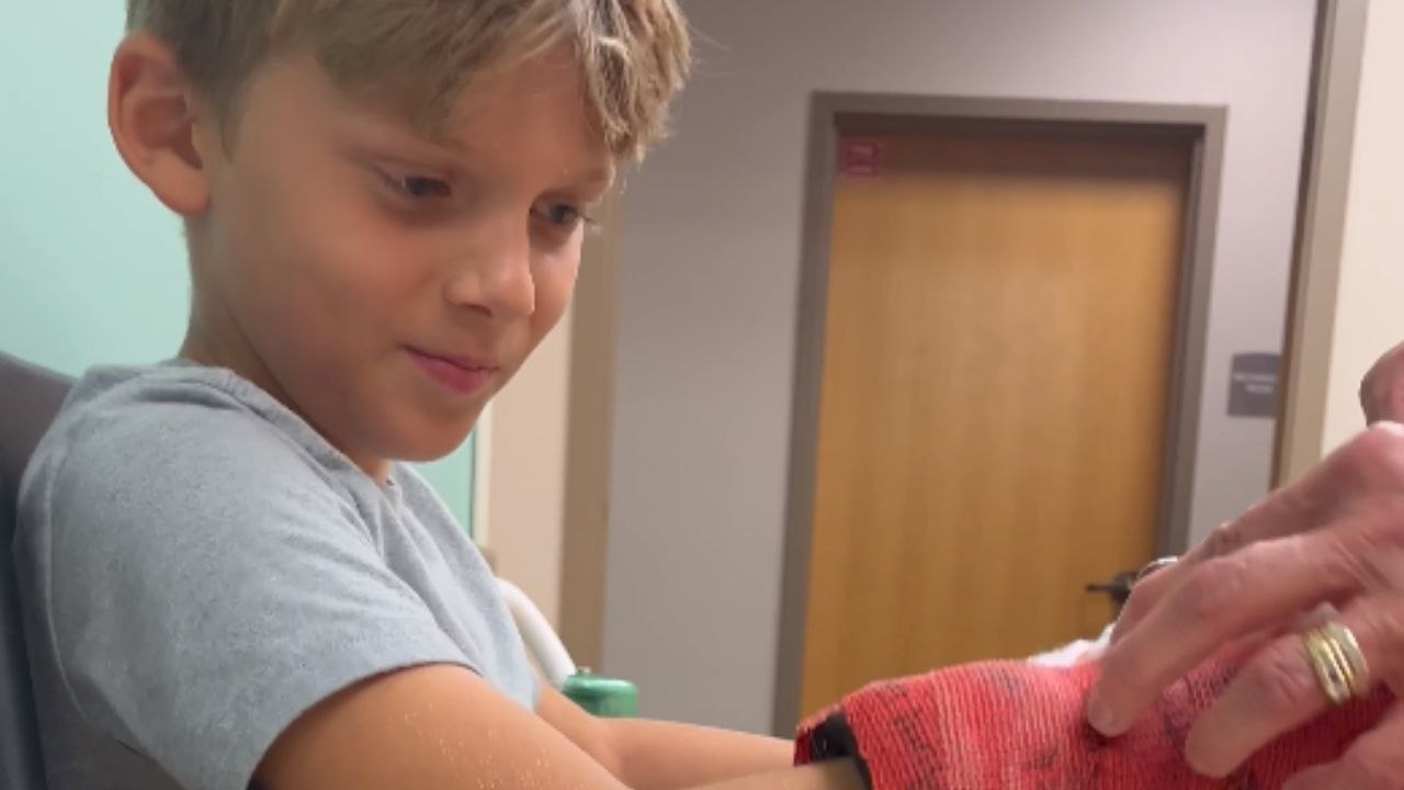 Boy surprised to see a rubber stuck to his wrist after cast removal ...