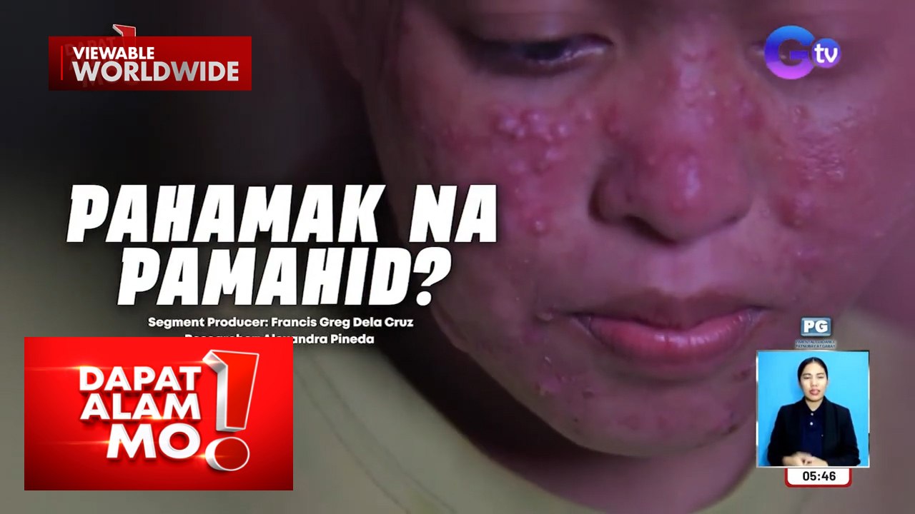 Pamahid na nabili, mas pinalala umano ang tigyawat ng isang babae ...