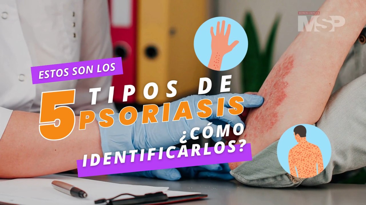 Los 5 tipos de psoriasis que existen: ¿Cómo identificarlos? - # ...