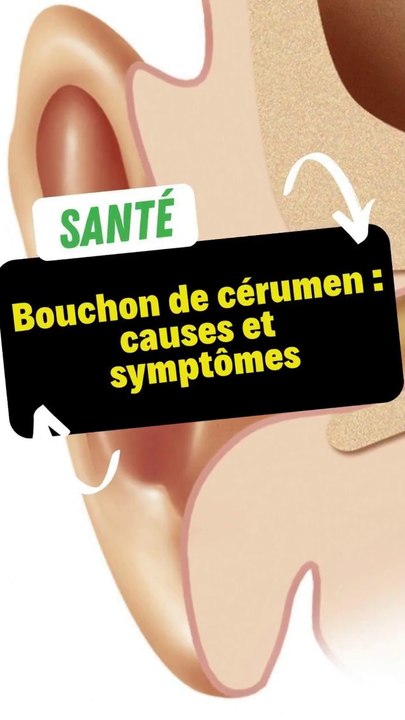 Bouchon de cérumen : causes et symptômes - Vidéo Dailymotion