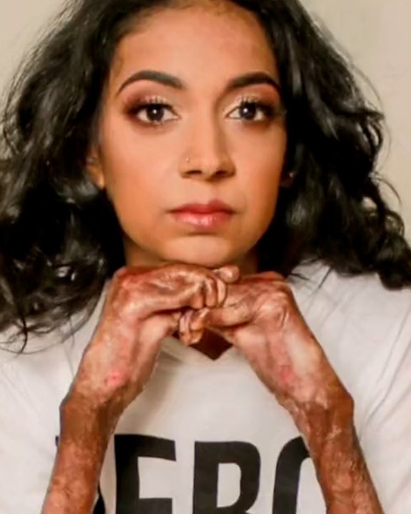 Growing Up With ‘Butterfly Skin': Meet the Woman With Skin as Fragile ...