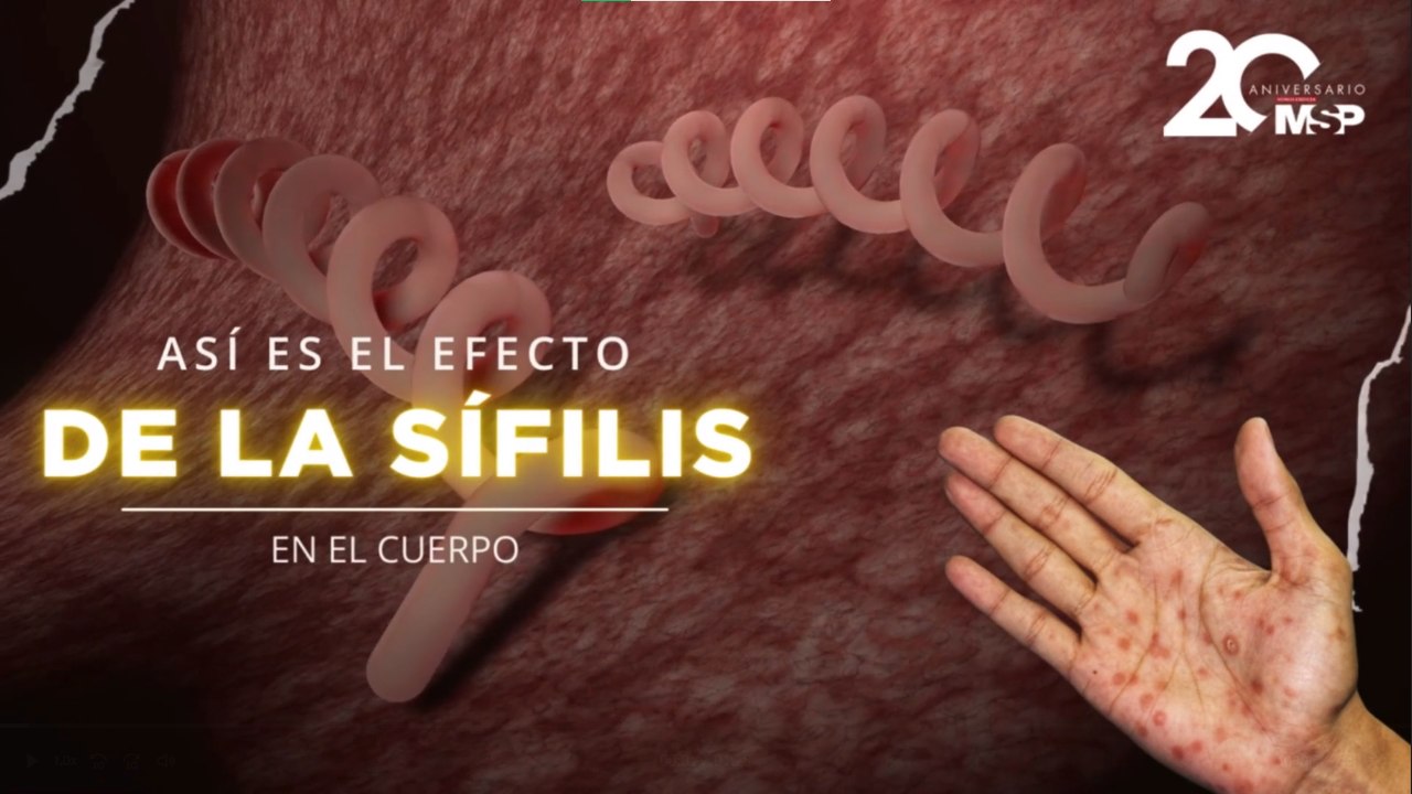 Así es el efecto de la sífilis en todo el cuerpo - #ExclusivoMSP ...