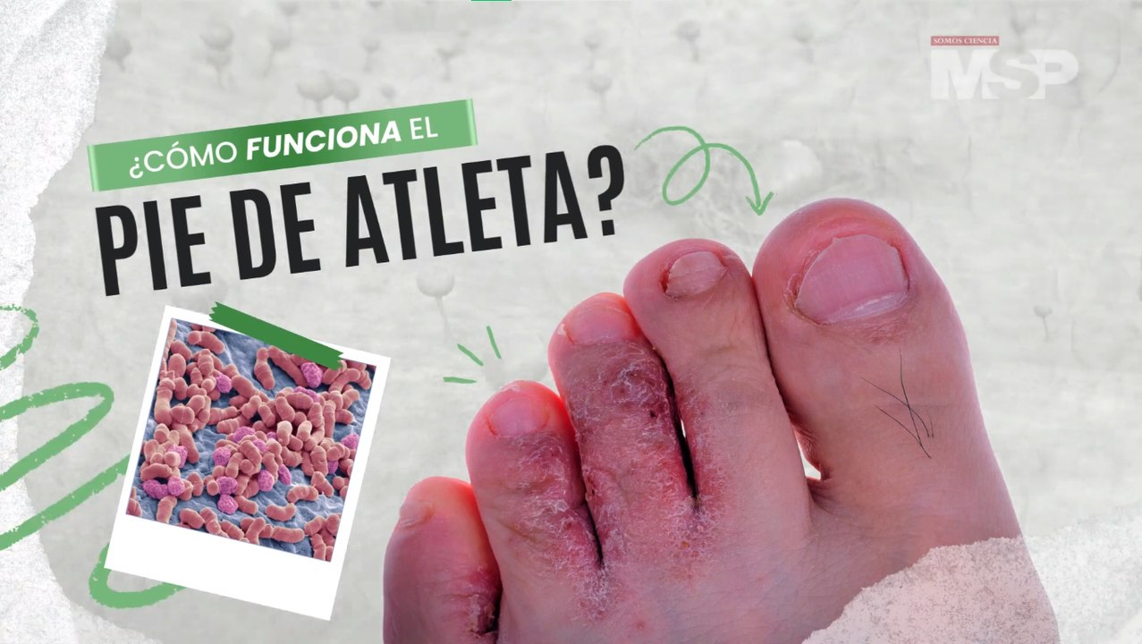 Mal olor, picor y hongos en los pies: así funciona el “Pie de atleta ...