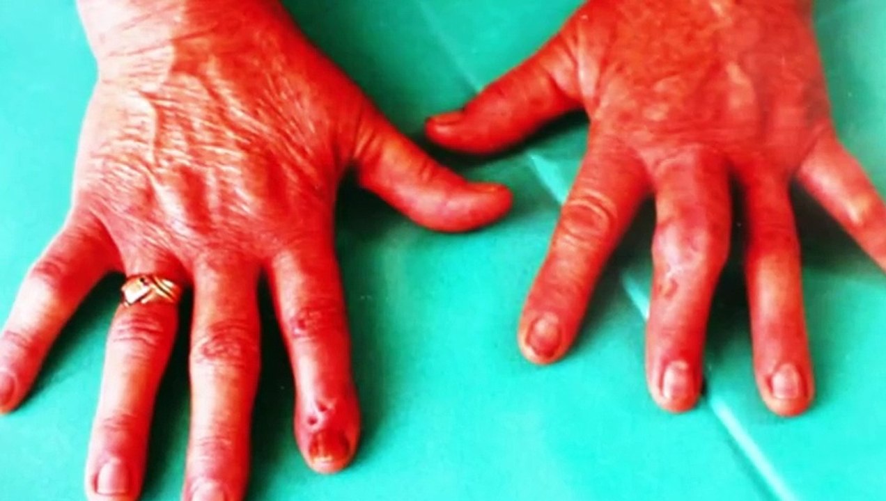 Psoriatic Arthritis vs. Rheumatoid Arthritis vs. Osteoarthritis- The ...