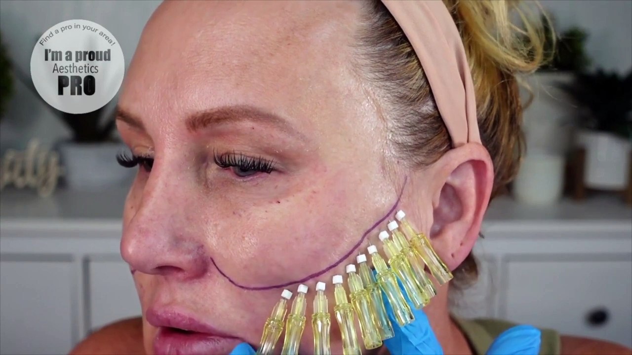 DIY Thread Series: Cheek Thread Lift - video Dailymotion