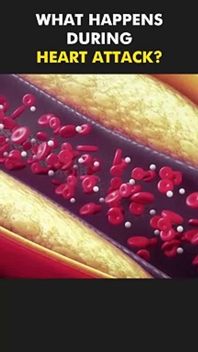 What Happens During Heart Attack? - video Dailymotion