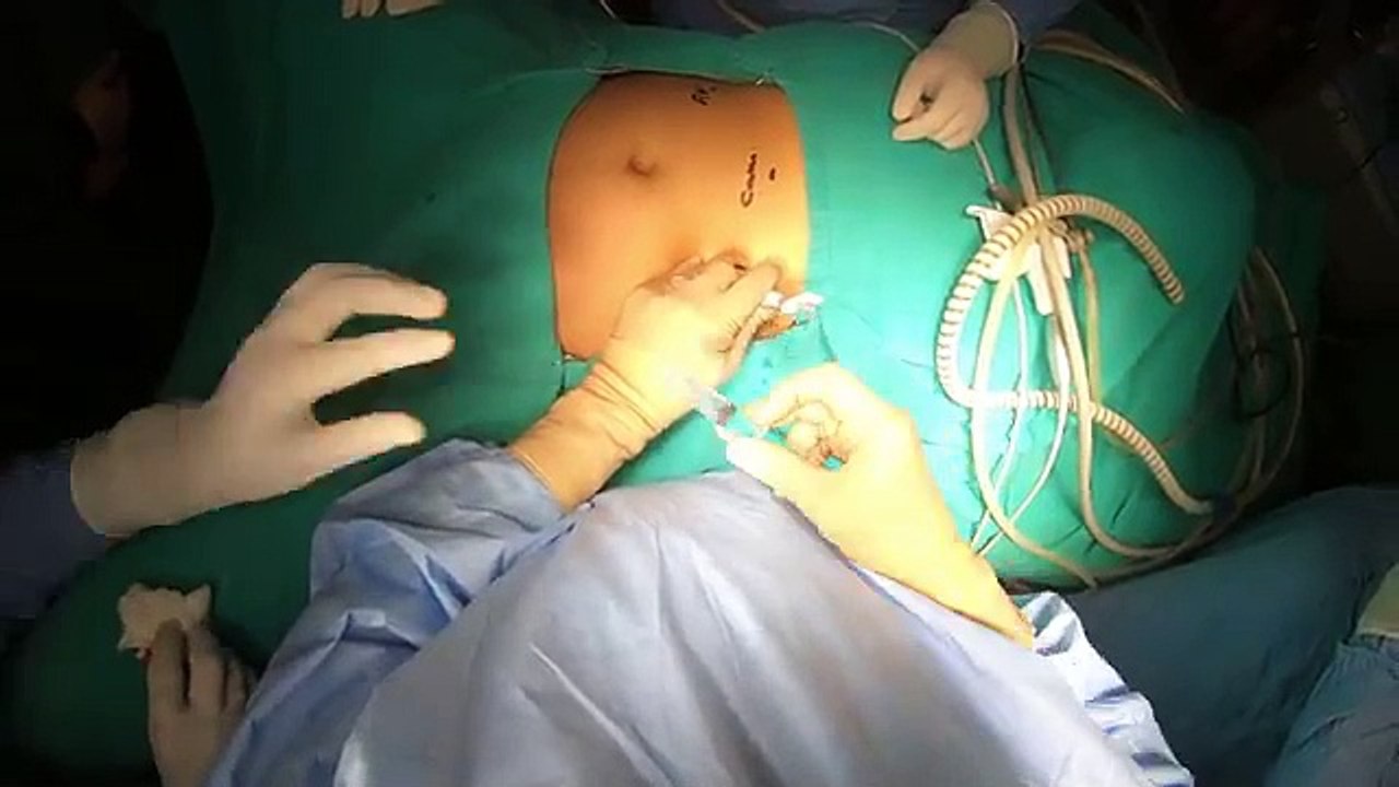 Laparoscopic Myomectomy for Large Intramural Fibroid Uterus - video ...
