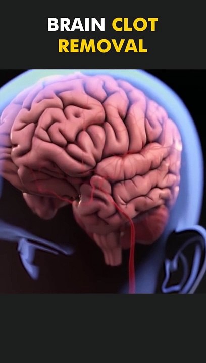 Brain Blood Clot Removal Technique 3D Animation - video Dailymotion