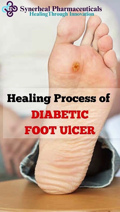 Healing process of Diabetic foot ulcer using SEESKIN AB, Collamycin ...