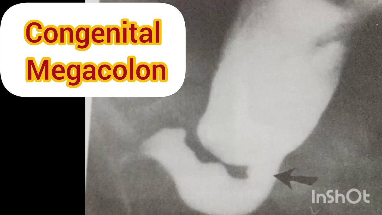 Congenital Megacolon/learn clinical anatomy - video Dailymotion