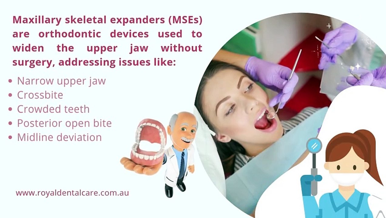 Maxillary Skeletal Expanders (MSE) - A Quick Guide - video Dailymotion