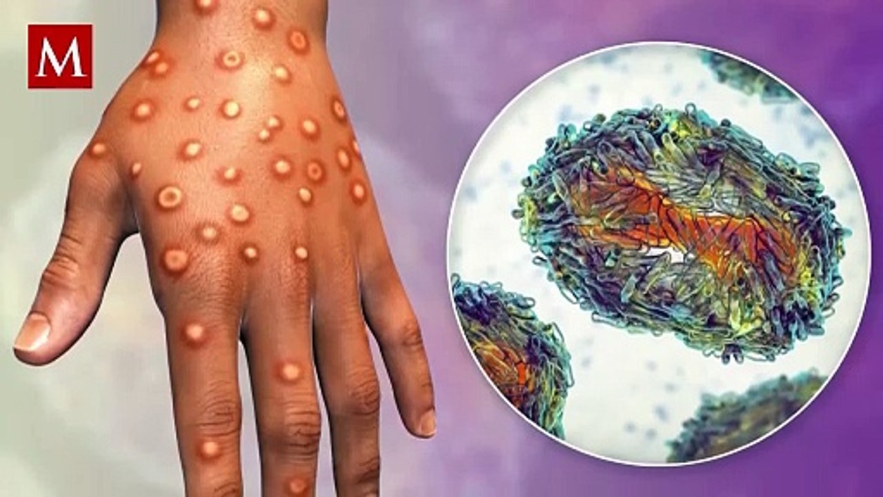 México acumula 55 contagios de Mpox; ¿es posible atender la enfermedad ...