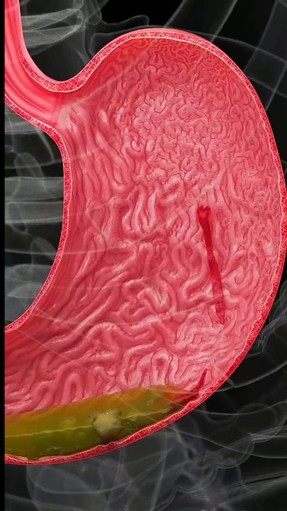 Hemorrhagic Gastric Ulcers Explained Causes of Bleeding Stomach Ulcers ...