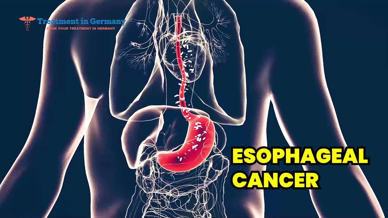 Esophageal Cancer - video Dailymotion