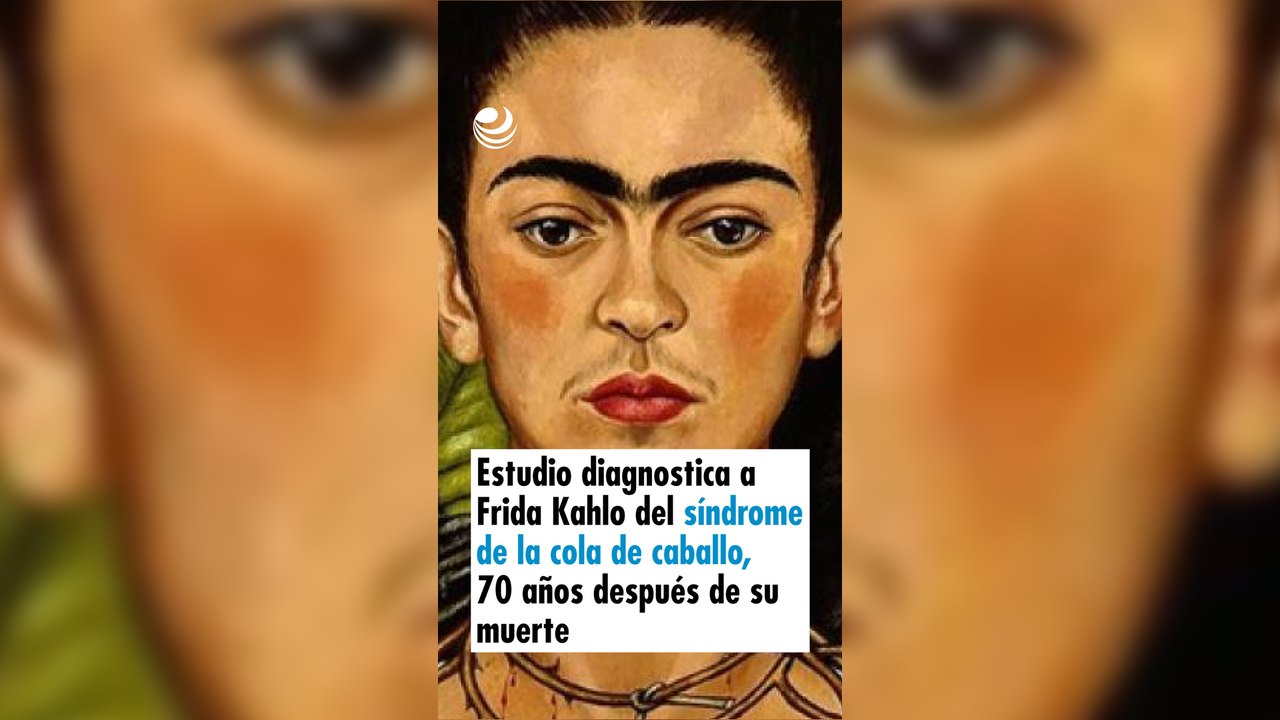 Estudio diagnostica a Frida Kahlo del síndrome de la cola de caballo ...