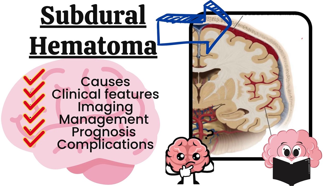 Subdural Hemorrhage (SDH) Explained: Causes, Symptoms, Diagnosis, and ...