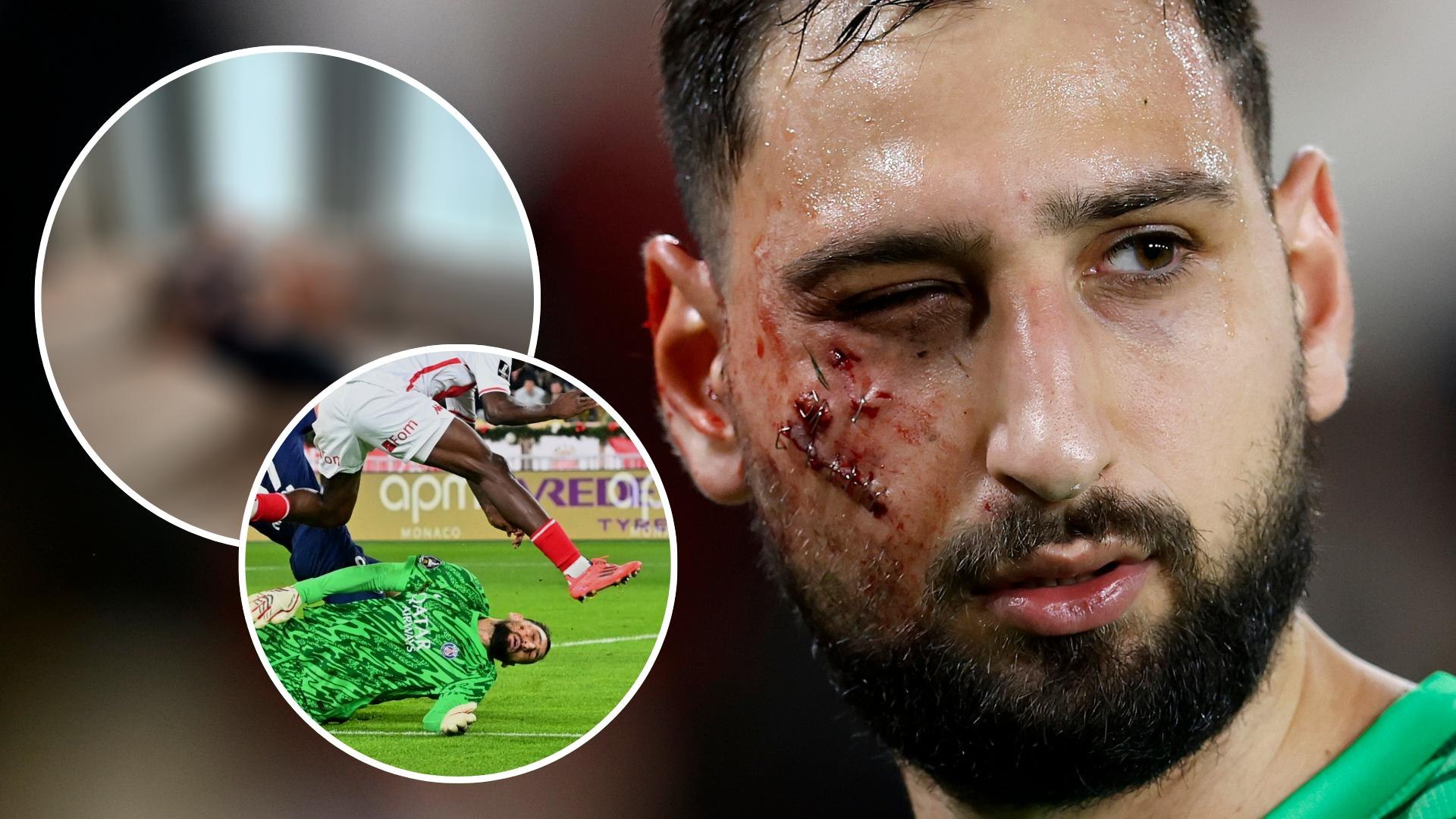 (PHOTOS) Gianluigi Donnarumma Shares Update After Suffering Brutal Blow ...