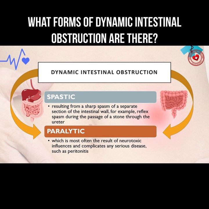 What forms of dynamic intestinal obstruction are there? - video Dailymotion