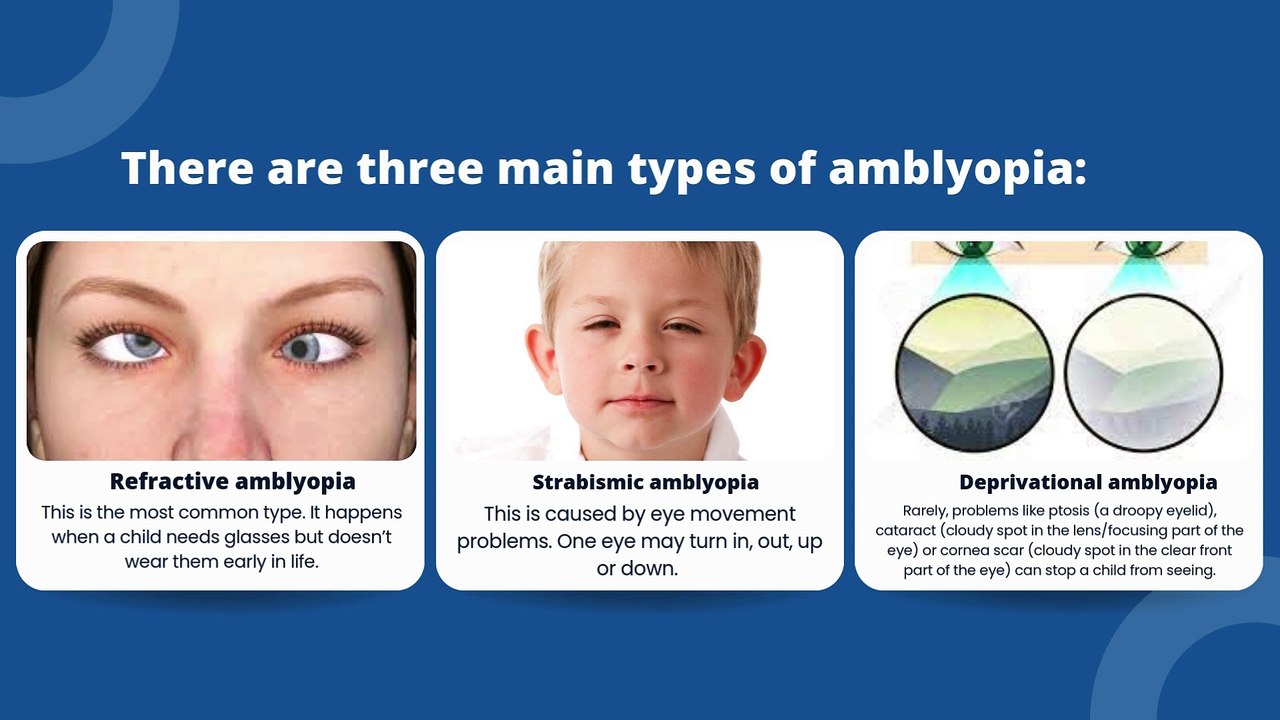 Amblyopia (Lazy Eye) Explained By Dr K Warraich #Amblyopia #lazyeye ...