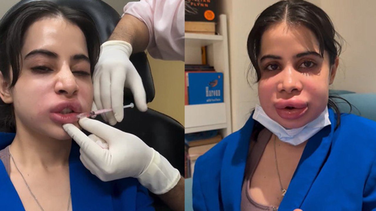 Urfi Javed Lip Fillers Video : कितना होता है Swelling Treatment और Cost ...