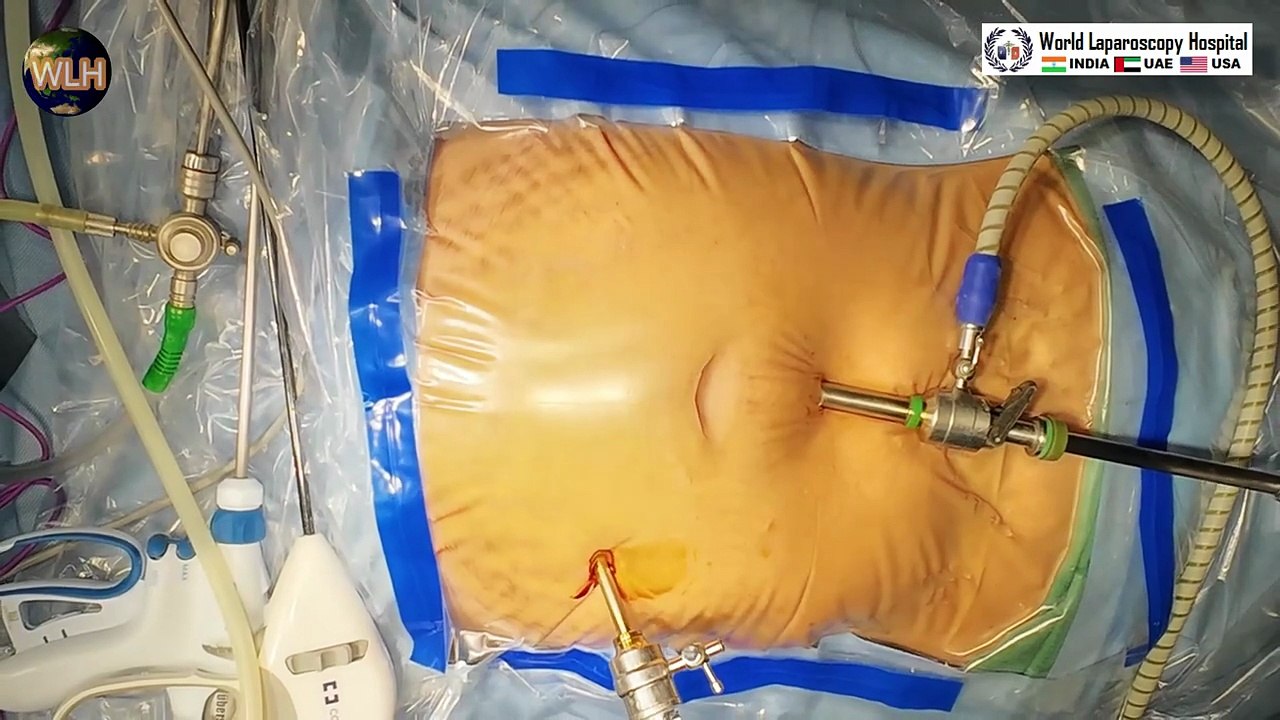 Enhancing Laparoscopic Hysterectomy Surgery_ TLH and BSO with ICG ...